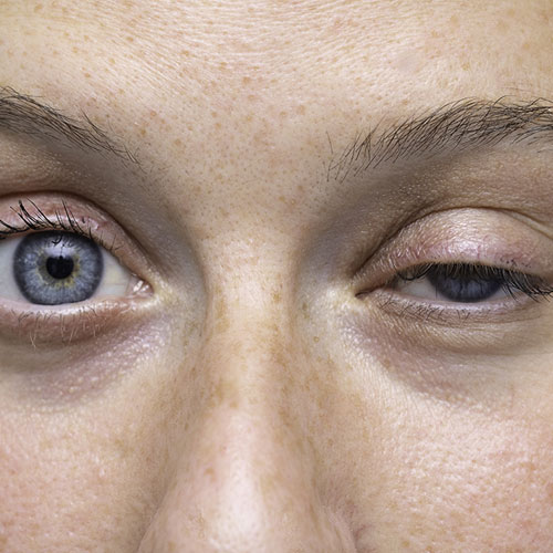 A Correção Da Ptose Adquirida | Ptose palpebral : o que é, sintomas e ...
